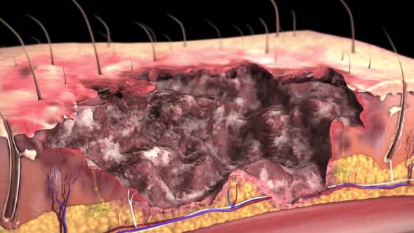 First Degree Burn epidermis 3d, Motion Graphics | VideoHive