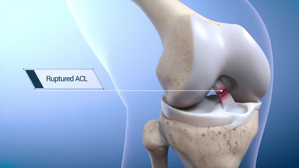 Anterior Cruciate Ligament (ACL) Injury or Tear, Motion Graphics ...