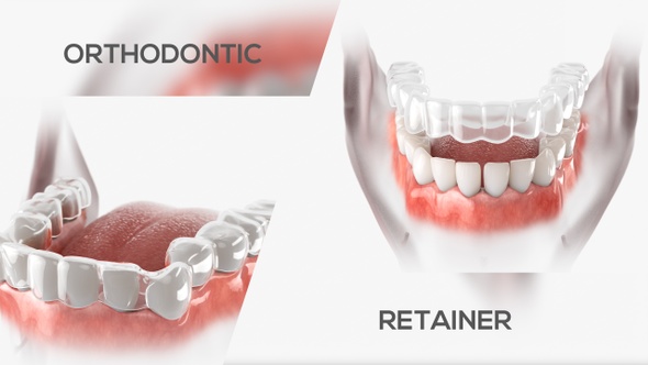 Orthodontic retainer, Motion Graphics | VideoHive