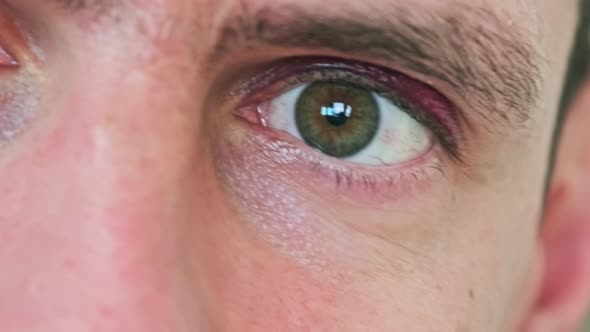 Bruise Over the Eye of a Man Closeup, Stock Footage | VideoHive