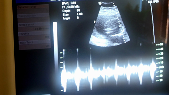 Heart Ultrasound On Computer Screen, Stock Footage | VideoHive