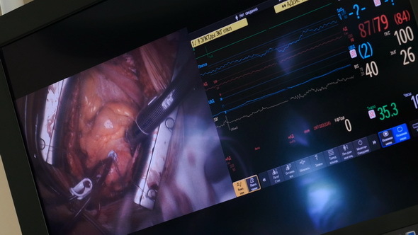 Open Heart Surgery, Stock Footage | VideoHive