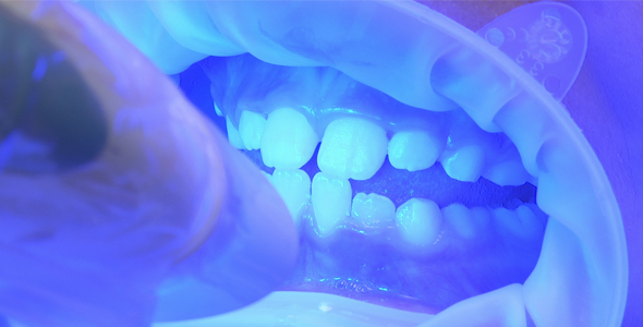 UV Whitening Teeth, Stock Footage | VideoHive