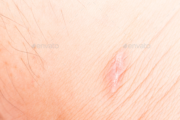 Scar on skin after recovered Stock Photo by ThamKC | PhotoDune