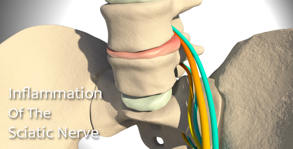 Inflammation Of The Sciatic Nerve, Motion Graphics | VideoHive
