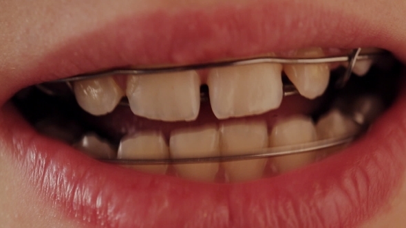 Dental Plate In The Teeth, Stock Footage | VideoHive