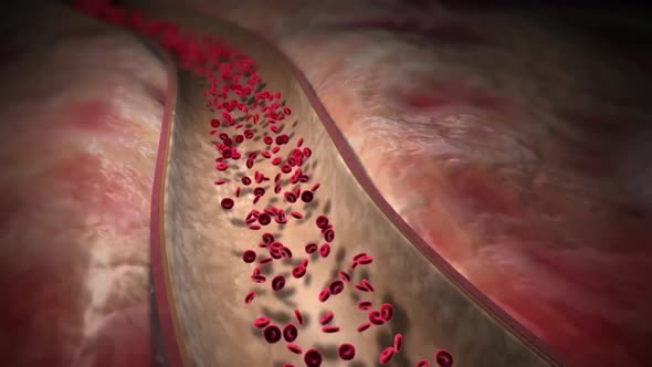 Plaque can damage the lining of blood vessels and cause a clot to form ...