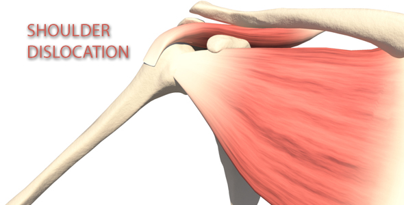 Shoulder Dislocation, Motion Graphics | VideoHive