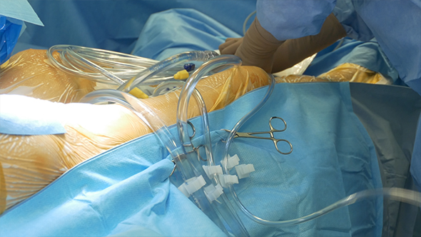 Arrange Drainage Tubes on Surgery, Stock Footage | VideoHive