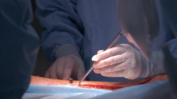 Closeup of Doctors Hands Operating a Patient Conducting Open Cut ...