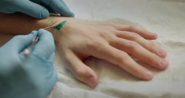 With a Wound on the Arm Removed Stitches at Home, Stock Footage | VideoHive