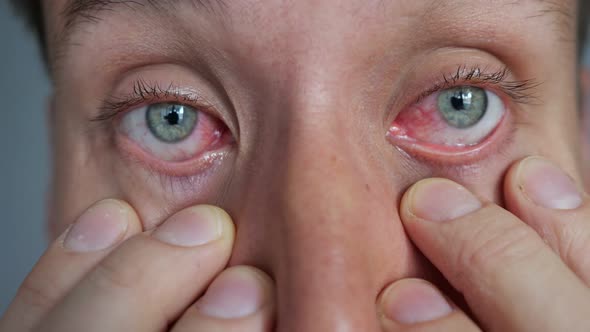 Young Man Opens Red Eyes with Fingers, Stock Footage | VideoHive