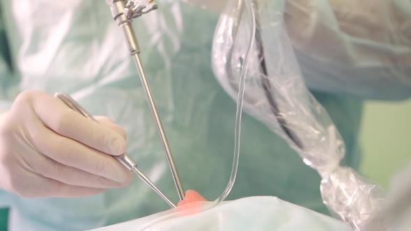 Doctor Performs Endoscopic Surgery Removing a Brain Tumor., Stock Footage