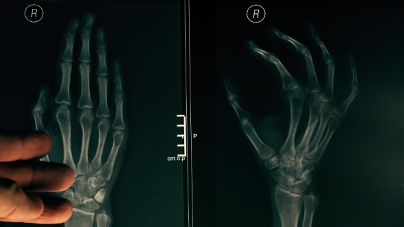 Doctor Explaining X-ray Image of a Hand To a Patient, Stock Footage
