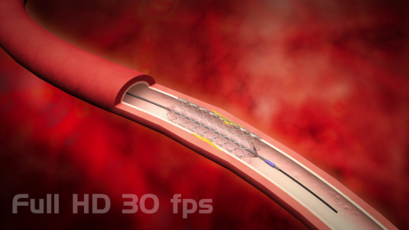 Angioplasty and stenting, Motion Graphics | VideoHive