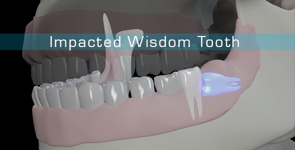 Impacted Wisdom Tooth, Motion Graphics | VideoHive