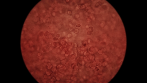 Microbe, Bacteria in the Blood Fighting for Life, Under the Microscope ...