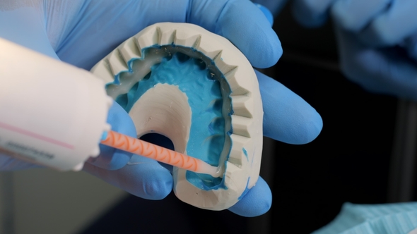 Establishment of Plastic Temporary Plate for Future Veneers. Dentist ...