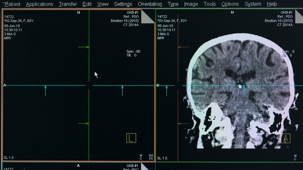 Process of Brain Scanning, Stock Footage | VideoHive