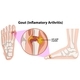 Human Anatomy of Gout, Vectors | GraphicRiver
