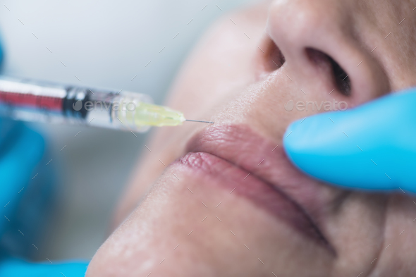 Hyaluronan Injection Face Treatment Stock Photo by microgen | PhotoDune
