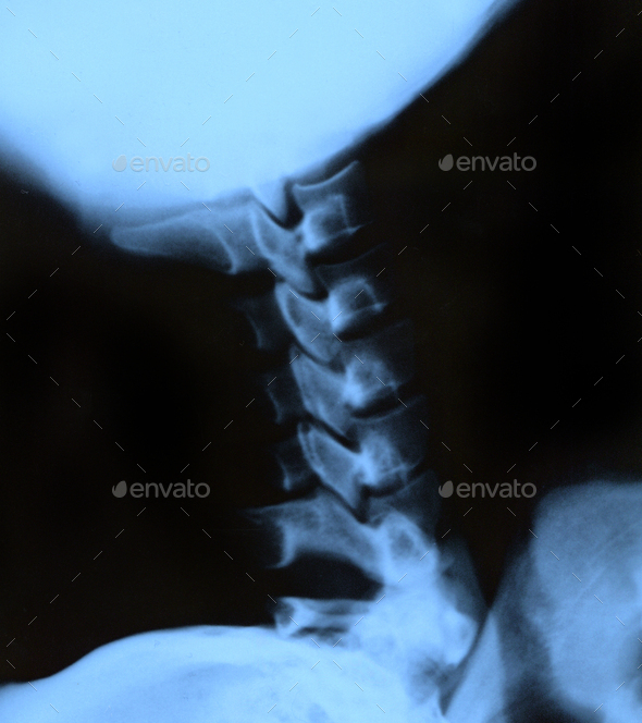 x-ray of the neck Stock Photo by AntonioGravante | PhotoDune