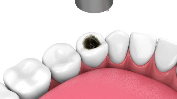 Removing tooth decay with dental laser without dental drill, Motion ...