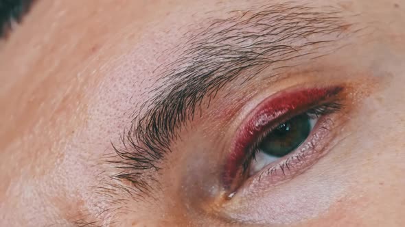 Real Black Eye on the Young Male Face Bruise on a Man Eyelid, Stock Footage