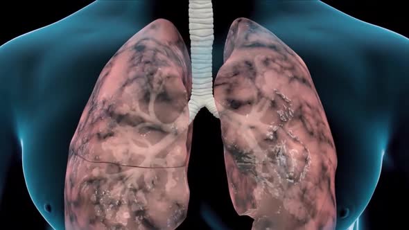 damaged lung anatomy 3d medical, Motion Graphics | VideoHive