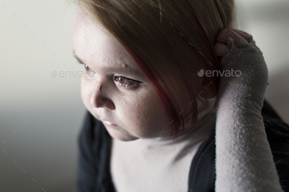 Portrait of disabled young woman crying Stock Photo by astrakanimages