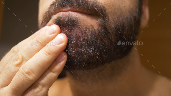 Seborrheic dermatitis in the beard Stock Photo by AntonioGravante ...
