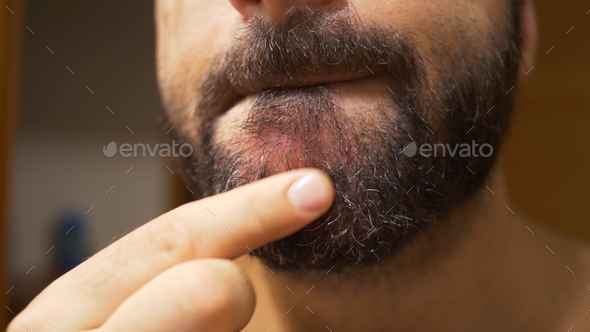 Seborrheic dermatitis in the beard Stock Photo by AntonioGravante ...