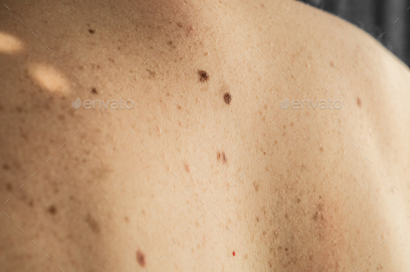 Skin on a man back with scattered moles Stock Photo by StiahailoAnastasiia