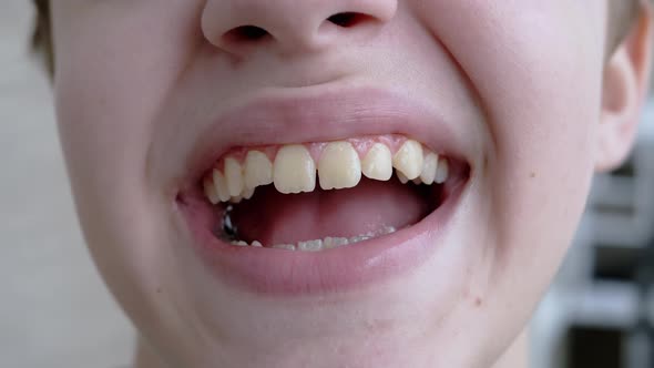 Closeup of the Face of a Smiling Child Showing Teeth, Stock Footage