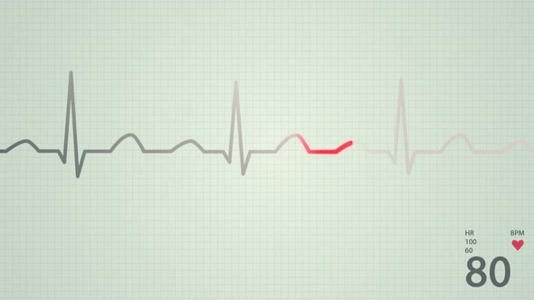 Animation of a schematic diagram of normal sinus rhythm for a human ...