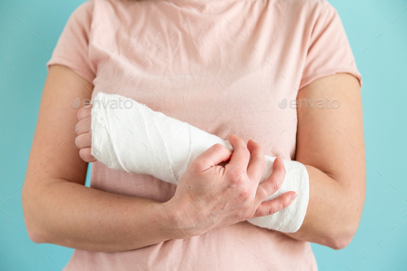 Woman with broken arm. Hand in a plaster bandage. Gypsum medical Stock ...