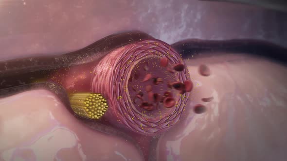 Extravasation, leakage of vesicant fluids or drugs from the vein into ...