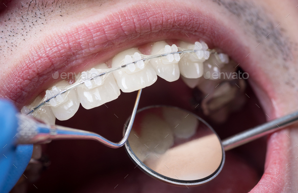 Dentist checking up teeth with ceramic brackets using dental tools ...