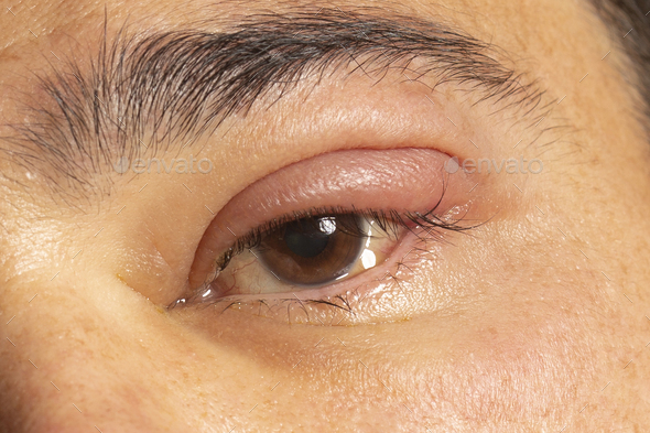 Inflamed eye with infected stye, upper eyelid, ophthalmic medicine ...