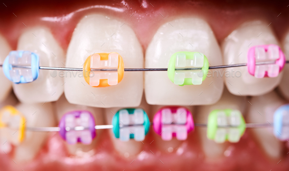 Orthodontic brackets with rubber bands on patient teeth. Stock Photo by ...