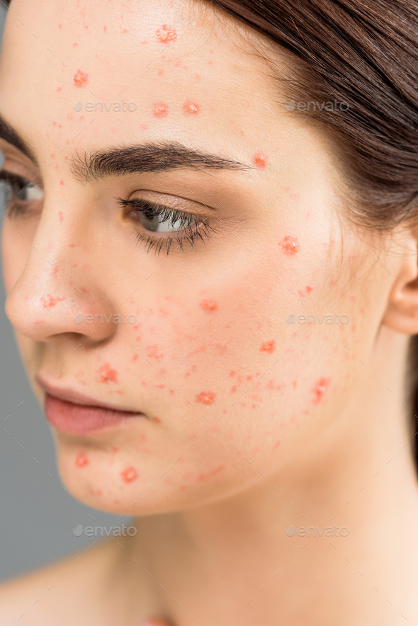 close up of young brunette woman with pimples on face isolated on grey ...