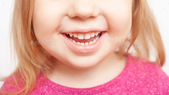Girl child smiling, white teeth after brushing and whitening, childhood ...