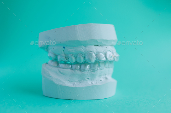 Plaster model of the human jaw with transparent silicone essix retainer ...