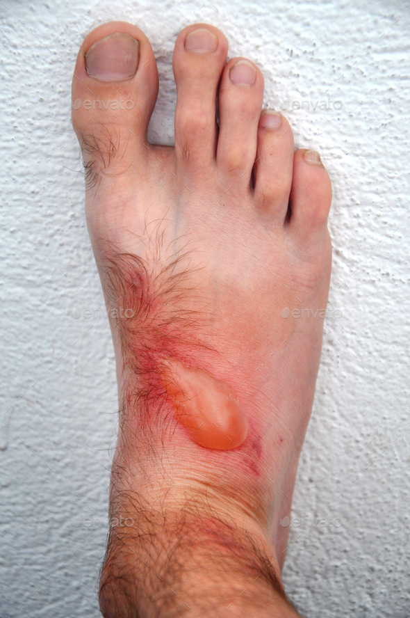 Phytophotodermatitis, cutaneous phototoxic skin inflammatory eruption ...