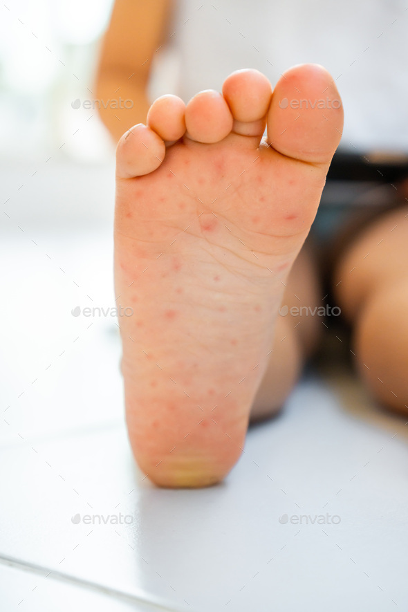 Enterovirus Leg - arm - mouth. Rash on the body of a child. Cocksackie ...