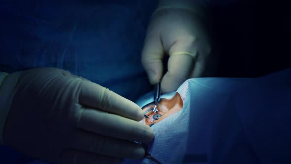 Surgeon operating eye of patient at the operating room, Stock Footage