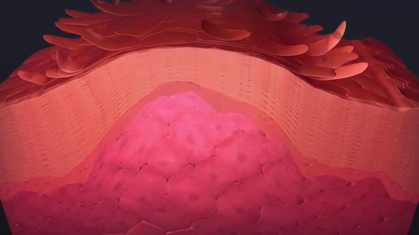 Skin cancer animation.Tumor growing under skin tissue, Motion Graphics