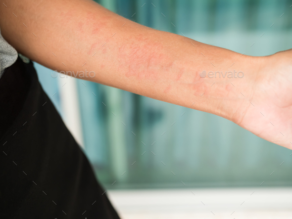 Hand woman non-lethal type from food and air poisoning Stock Photo by ...