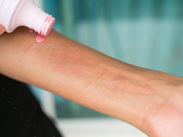 Urticaria on hand woman non-lethal type from food and air poisoning ...