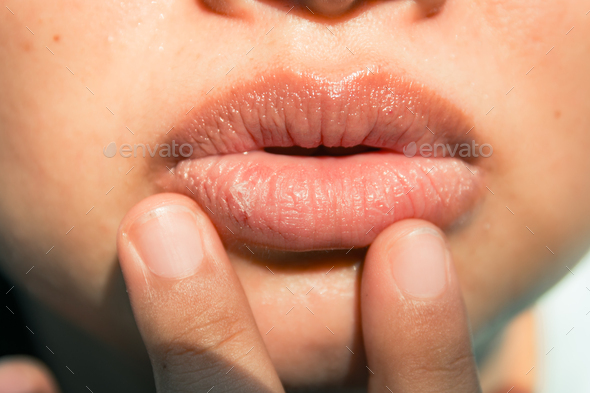 Closeup asian woman face with brittle and dry lips, concept lip salve ...